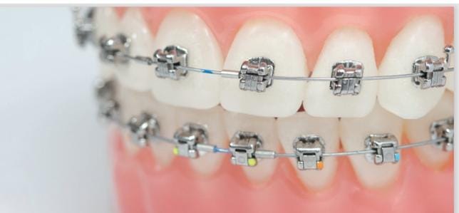 Damon Braces